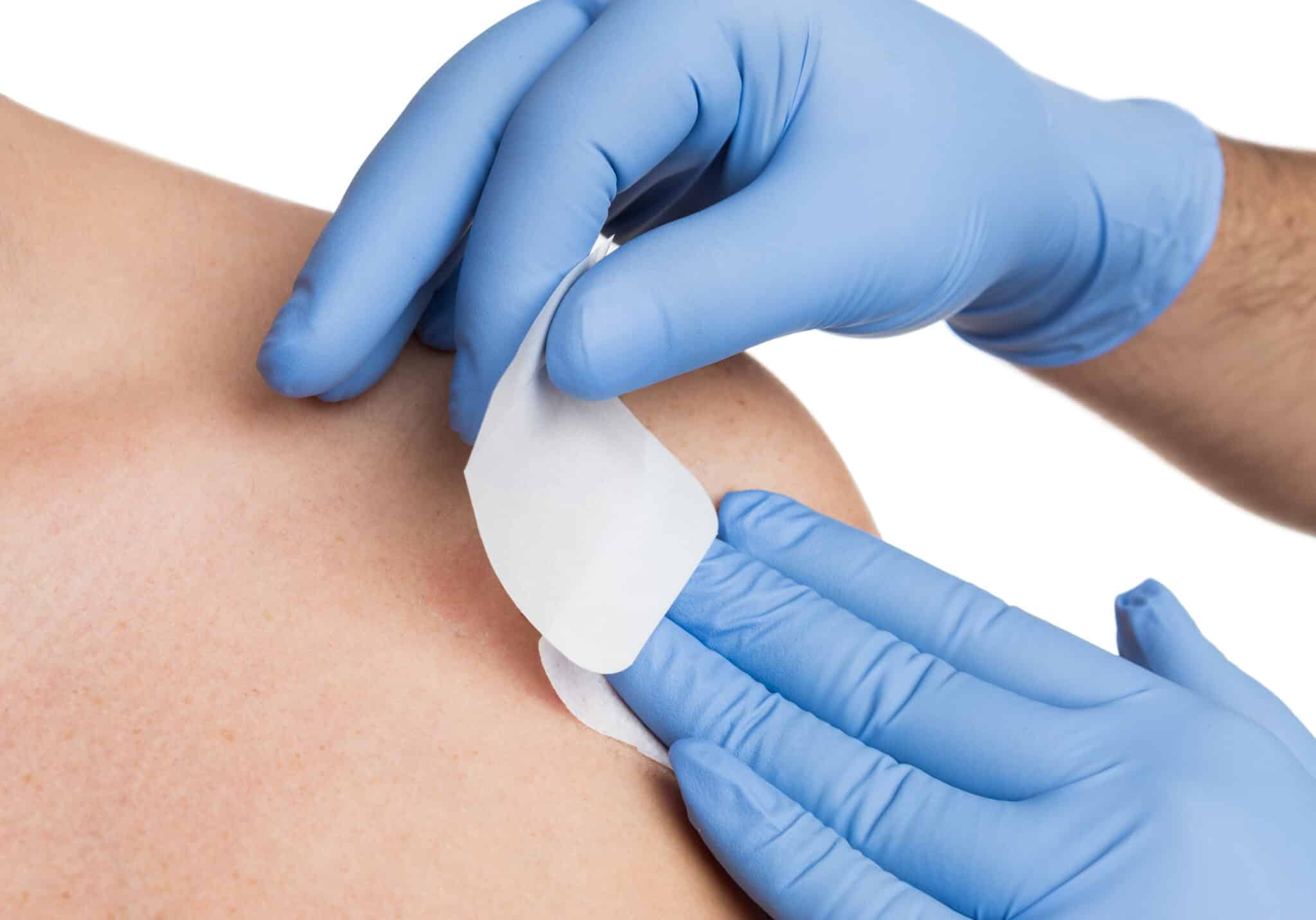 Recovery After Mohs Surgery, Skin & Beauty Center, Los Angeles, CA